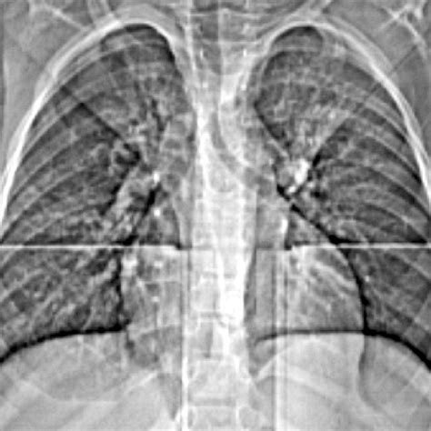 Severe Bulbo Duodenitis With Mild Diffuse Bleeding Download