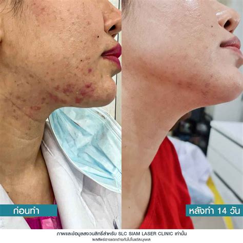 Pico Plus Laser ทวงคืนผิวสวย รักษาหลุมสิว รอยสิว ฝ้า รอยสัก ผิวไม่