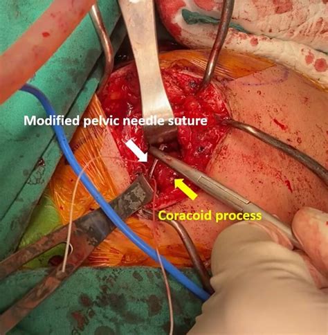 The Surgeon Can Easily Loop A Suture Under The Coracoid Process Download Scientific Diagram