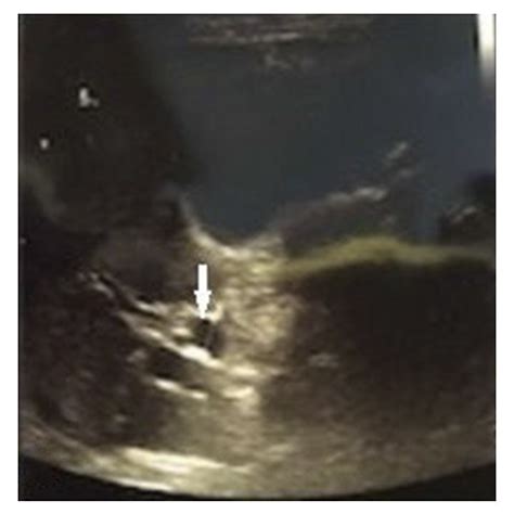 Abdominal Ultrasound Showing A Dilated Common Bile Duct 11 Mm Images