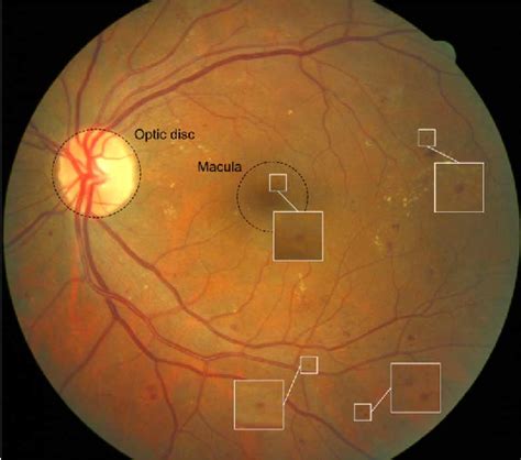 Figure 1 From Retinal Microaneurysm Detection Through Local Rotating Cross Section Profile