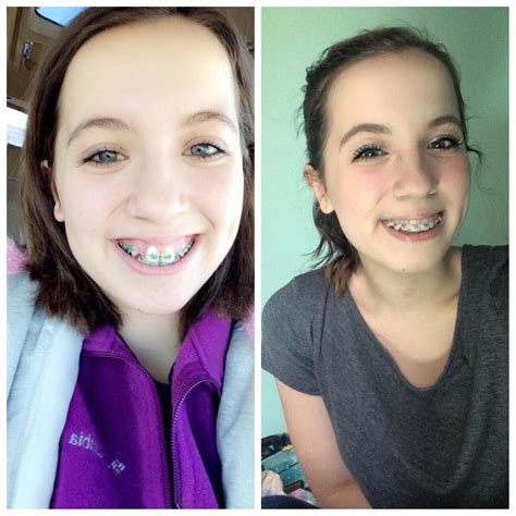 A Little Over A Year With Braces Just Got Rubber Bandsouch But I Am