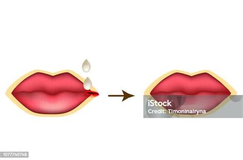 치료 균열 입술입니다 약물의 드롭입니다 인포 그래픽입니다 격리 된 배경 벡터 일러스트입니다 개념에 대한 스톡 벡터 아트 및 기타 이미지 Istock