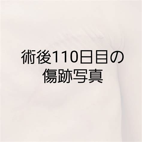乳がん全摘術手術後110日目抗ホルモン剤74日目・あぁ！痛い気がする！ 49歳 はじめての「がん」記録（宣告202308）