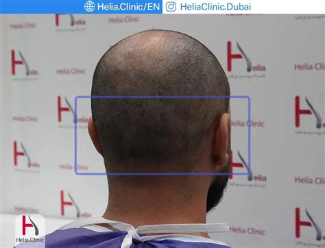 The Donor Area The Lifeline Zone Of Hair Restoration Helia Clinic