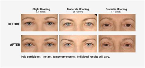 Alternative Treatments For Droopy Eyelids Contours Rx