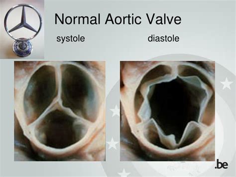 Aortic Valve Function Normal At Mason Jaques Blog