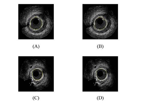 Comparison Between Images Automatically Segmented In B D And The