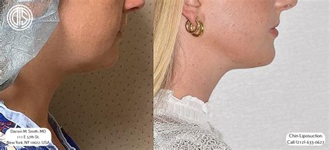 Lumps After Chin Lipo Everything You Need To Know