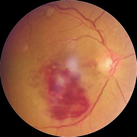 Ruptured Retinal Artery Macroaneurysm Retinara