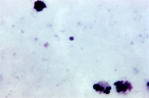 Free Picture Photomicrograph Shows Red Blood Cell Infection