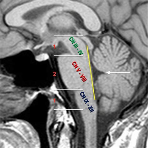 Pontine Diffuse Midline Glioma In A 4 Year Old Girl Ac Axial A And