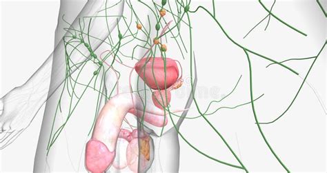 Stage I Testicular Cancer Is Characterized By A Tumor That Has Not Spread To The Lymph Nodes Or