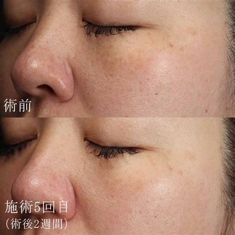 ピコスポットの症例写真・費用・リスク・副作用 美容皮膚科なら水の森美容クリニック