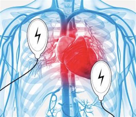 Procedure Instructions