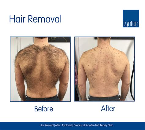 Does Laser Hair Removal Hurt Pain Free Hair Removal Lynton Clinic