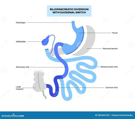 Biliopancreatic Diversion Procedure Vector Illustration Cartoondealer