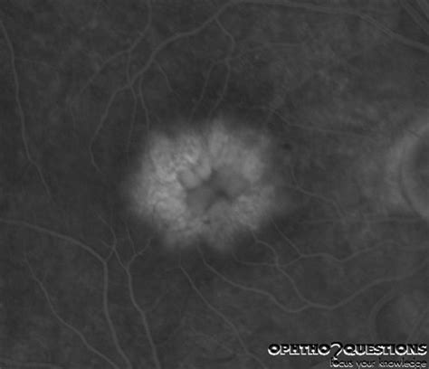 Uveitis Flashcards Quizlet