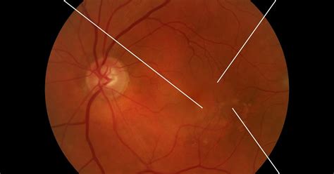 Polypoidal Choroidal Vasculopathy