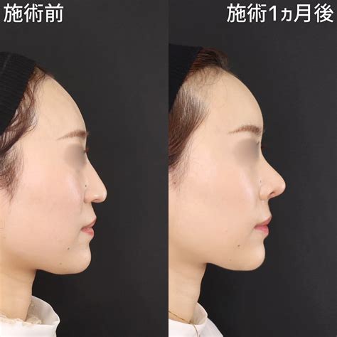 【鼻整形×脂肪注入】で横顔が一気に垢抜ける！｜症例写真・ビフォーアフター｜美容整形･美容外科のtaクリニックグループ