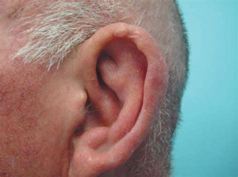 Scielo Brasil Prevalence Of Weathering Nodules Of The Ear In Patients