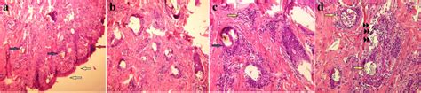 Histopathology Hande Results From The Skin Biopsies Taken From The