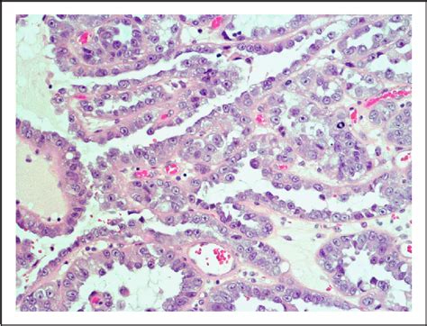 Figure 1 From Clear Cell Adenocarcinoma Of The Urethra Presenting With