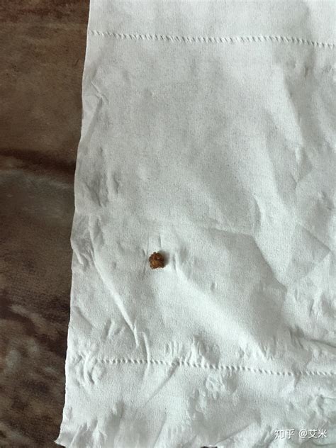 六天时间排出来肾结石这种经历再也不要了 知乎