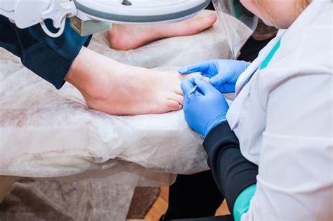 Corn Surgery Removal Cost