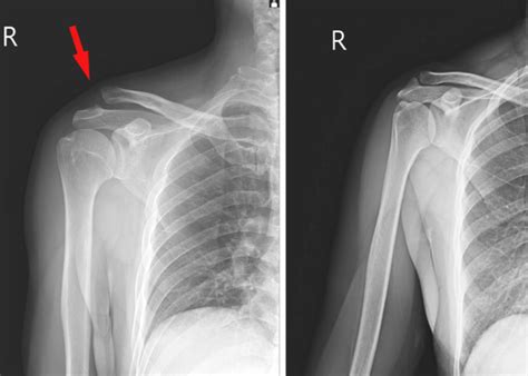 Ac Joint Repair Reconstruction Orthopedic Shoulder Doctor Sugar Land Pearland Houston Tx
