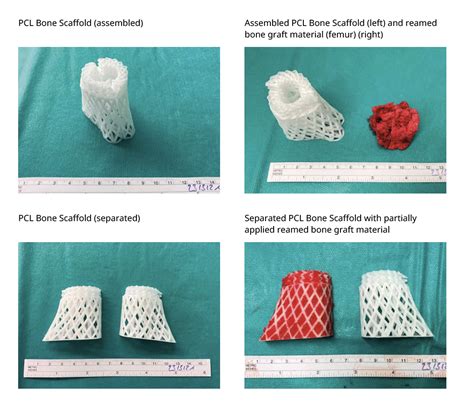 Pcl Bone Scaffold Bellaseno Restoring Health