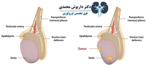 تومور بیضه در افرادی که سابقه جراحی بیضه نزول نکرده دارند علل، علائم