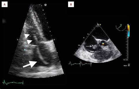 Transthoracic A And Transesophageal B Echocardiography