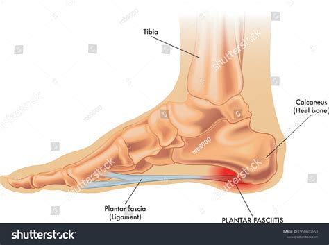 Illustration Anatomy Foot Symptoms Plantar Fasciitis Stock Vector Royalty Free 1958600653