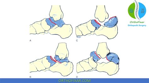 Talar Fractures And Dislocation Orthofixar 2026