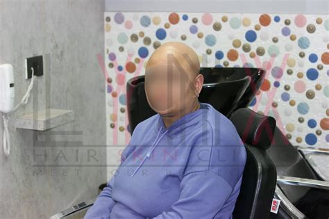 Prem Hair Expert — Wigs For Cancer Patients In Gurgaon