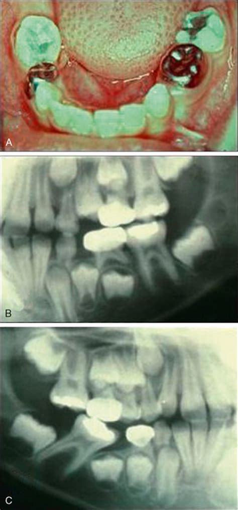 27 Managing The Developing Occlusion Pocket Dentistry