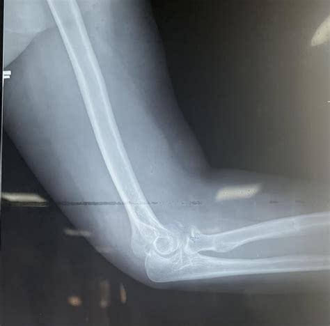 Broken Elbow R Brokenbones