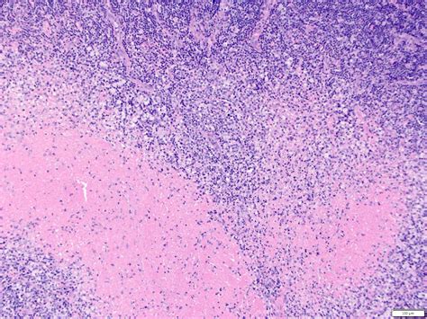 Pathology Outlines Kikuchi Disease