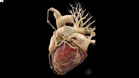 Sextuple Coronary Bypasses Siemens Healthineers