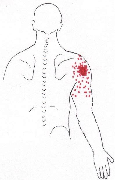 Teres Minor © Copyright American Academy Of Manual Medicine