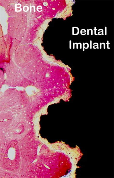 Primary Determining Factors To Be Considered For The Osseointegration Of A Dental Implant Dess®