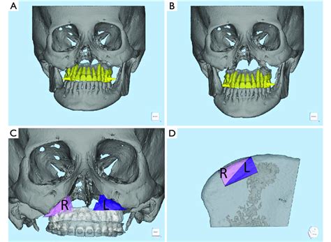 Three Dimensional Reconstruction Ab Determination Of The Maximum