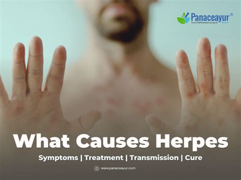 Herpes Simplex Virus Hsv Panaceayur