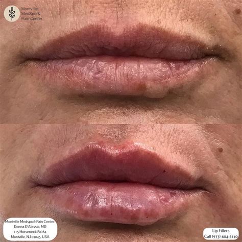 Lip Fillers Gone Wrong What To Do After A Botched Treatment