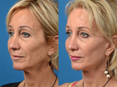 Facelift Photos Melbourne Fl Patient 52551