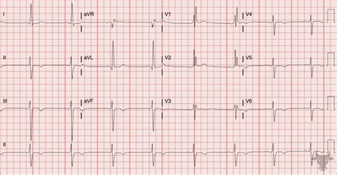 Left Anterior Fascicular Block Ecg Stampede
