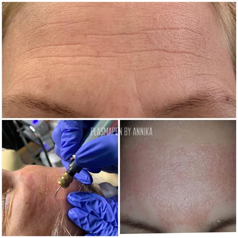 FIBROBLAST PLASMALIFTING Pärnu Kehastuudio
