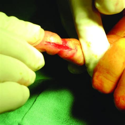 Longitudinal Bilateral Release Of The Constrictive Ring Download Scientific Diagram