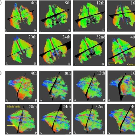 The Dti Tractography Of A Cerebral Cortex And B Whole Brain From 4